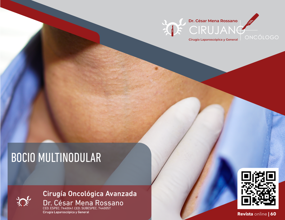 Bocio Multinodular – Dr. César Mena Rossano
